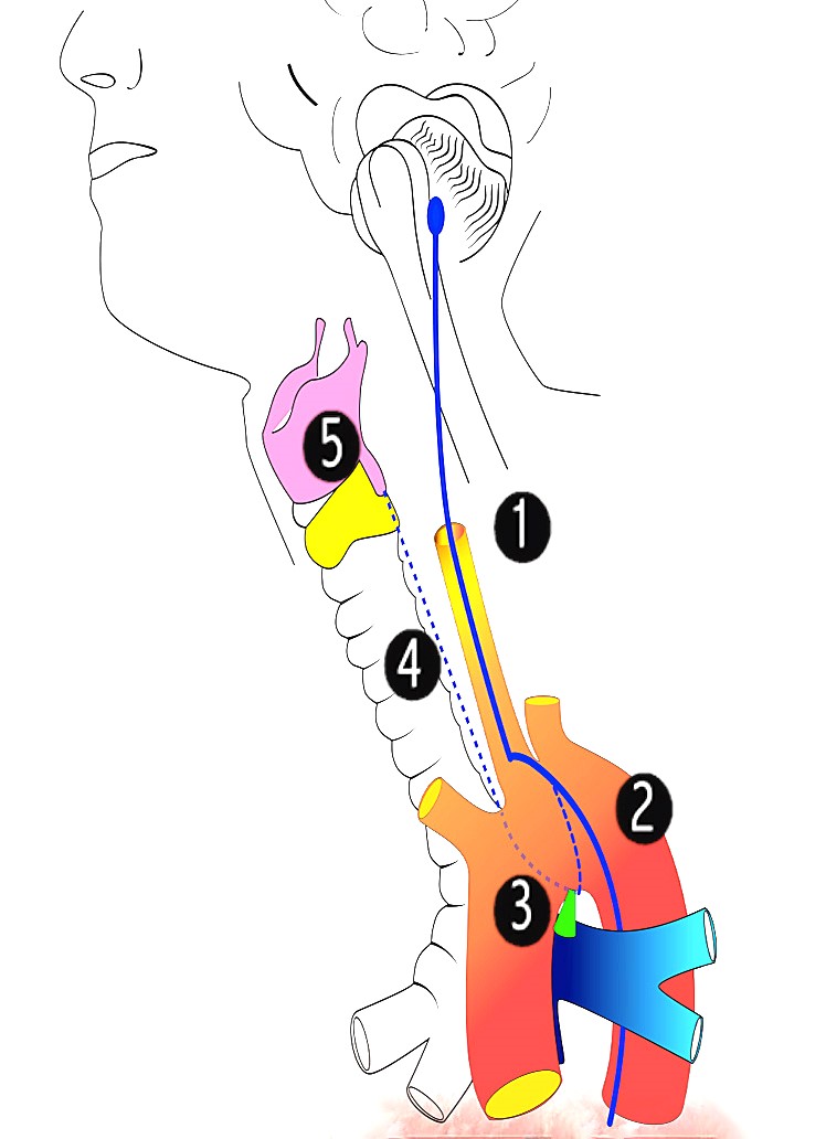 Recurrent Laryngeal Nerve